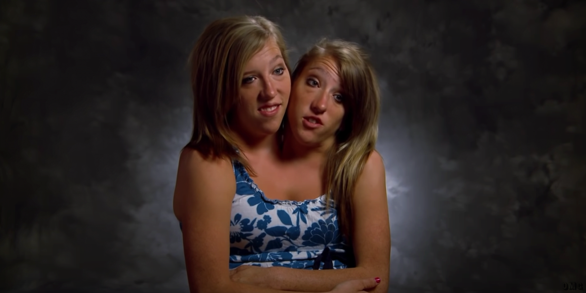 Years After These Siamese Twins Were Born, They Have Something To Share